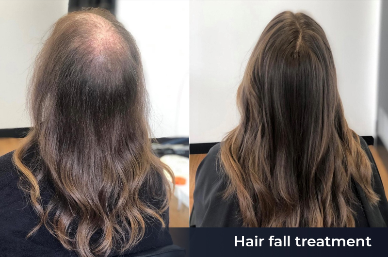 Best Botox treatment service in Hyderabad | Skin Diseases solution